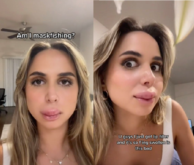 [News] Woman's lips disfigured after botched filler procedure ...